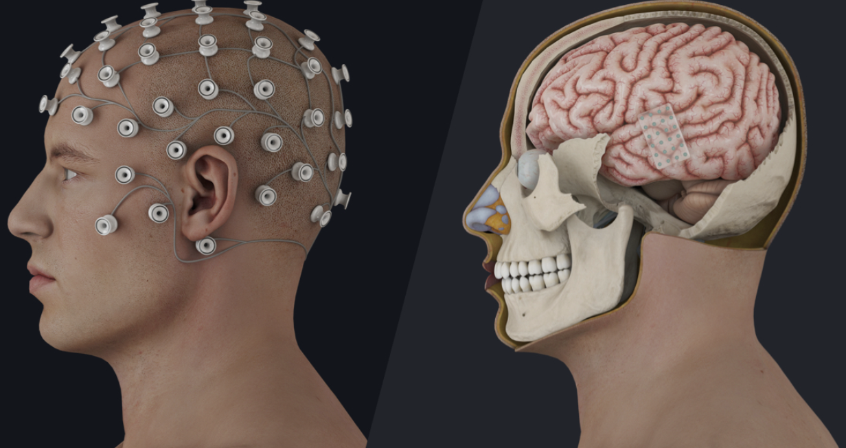 Mind Over Machine: How Brain-Computer Interfaces are Redefining Human ...